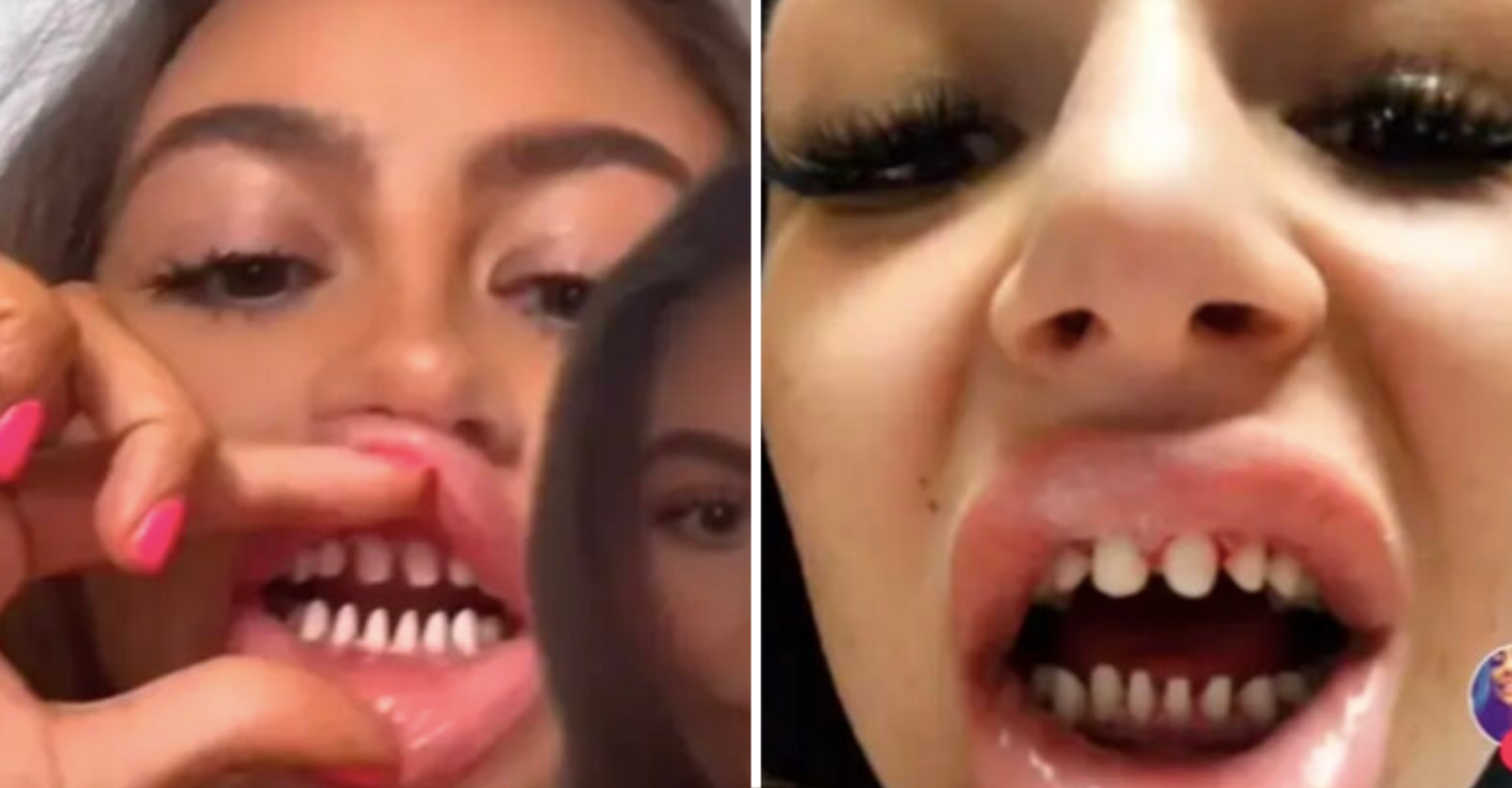Dentist Shares Warning Over TikTok's Growing 'Shark Teeth' Trend
