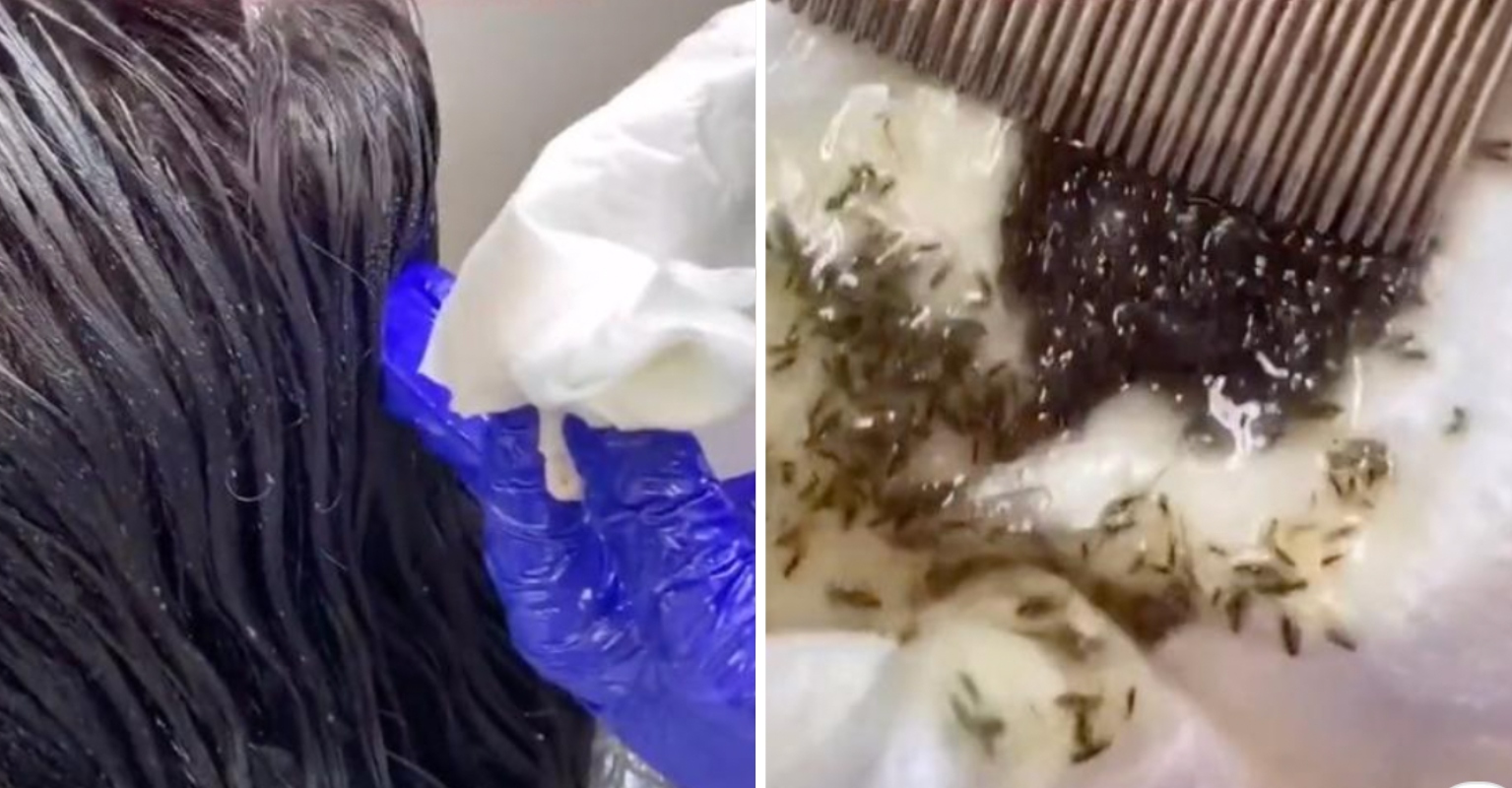 Experts Remove Extreme Head Lice Infestation After Five Years - And ...