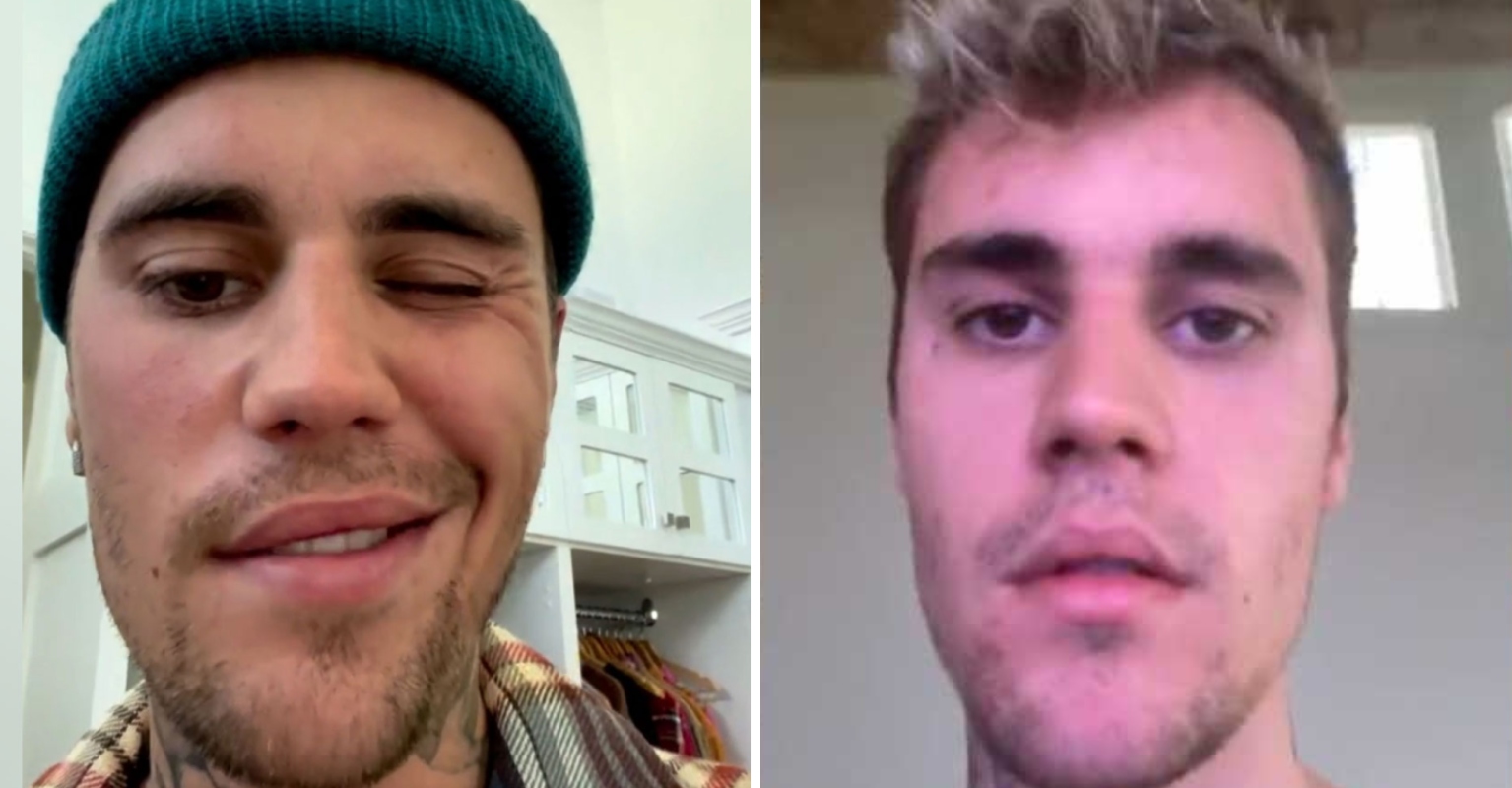 Justin Bieber Says He Is Struggling To Eat Amid Facial Paralysis Caused ...