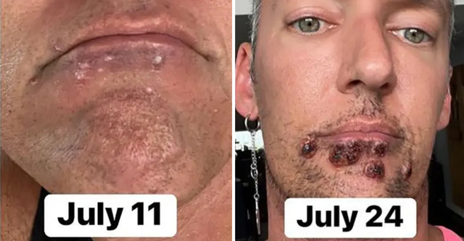 Monkeypox Patient Reveals How His Lesions Gradually Worsened In Daily ...