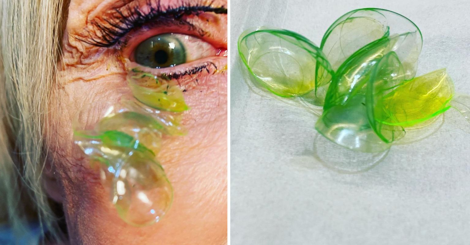 Doctor Shares Video Removing 23 Contact Lenses From Forgetful Patient’s Eye