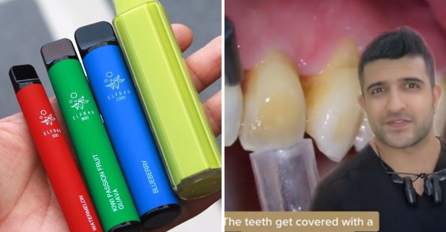 Dentist Shows The Effects Using Disposable Vapes Can Have On Your Teeth