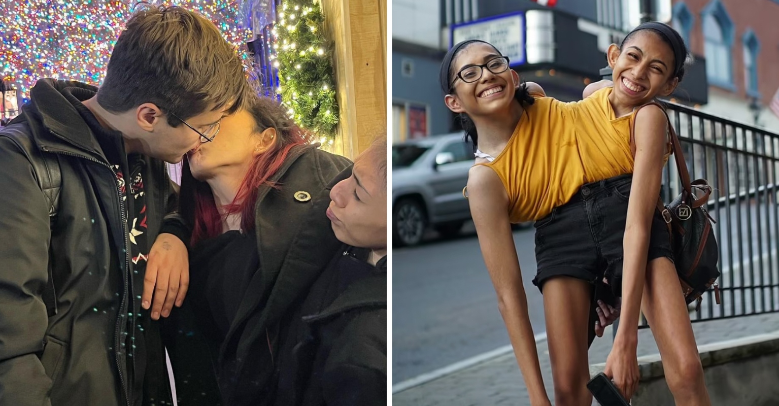 Conjoined Twin Explains How She's Been Dating Her Boyfriend For 18 Months