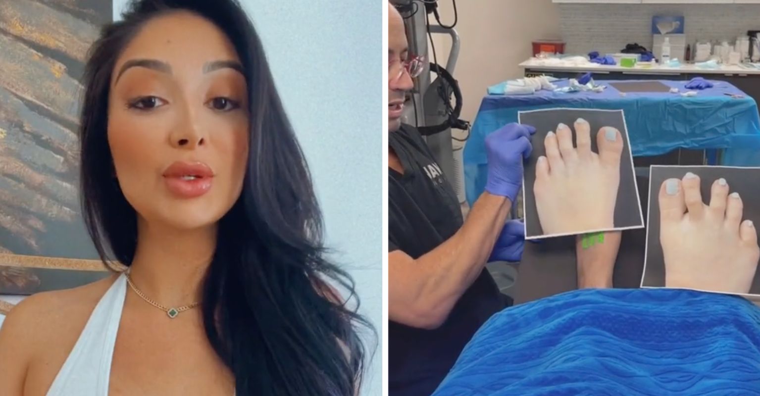 TikToker Gets Toe-Shortening Surgery After Years Of Feeling Insecure ...