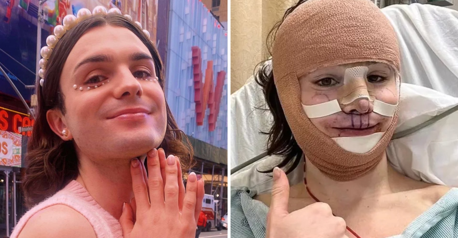 TikTok Influencer Dylan Mulvaney Shares Results Of Facial Feminization ...