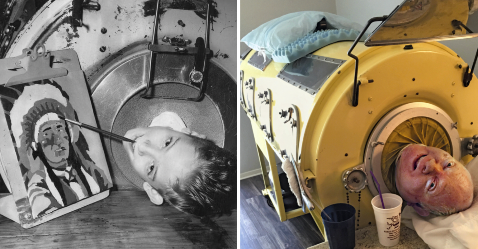Paralyzed Man Has Lived Inside An Iron Lung Machine For Over 60 Years