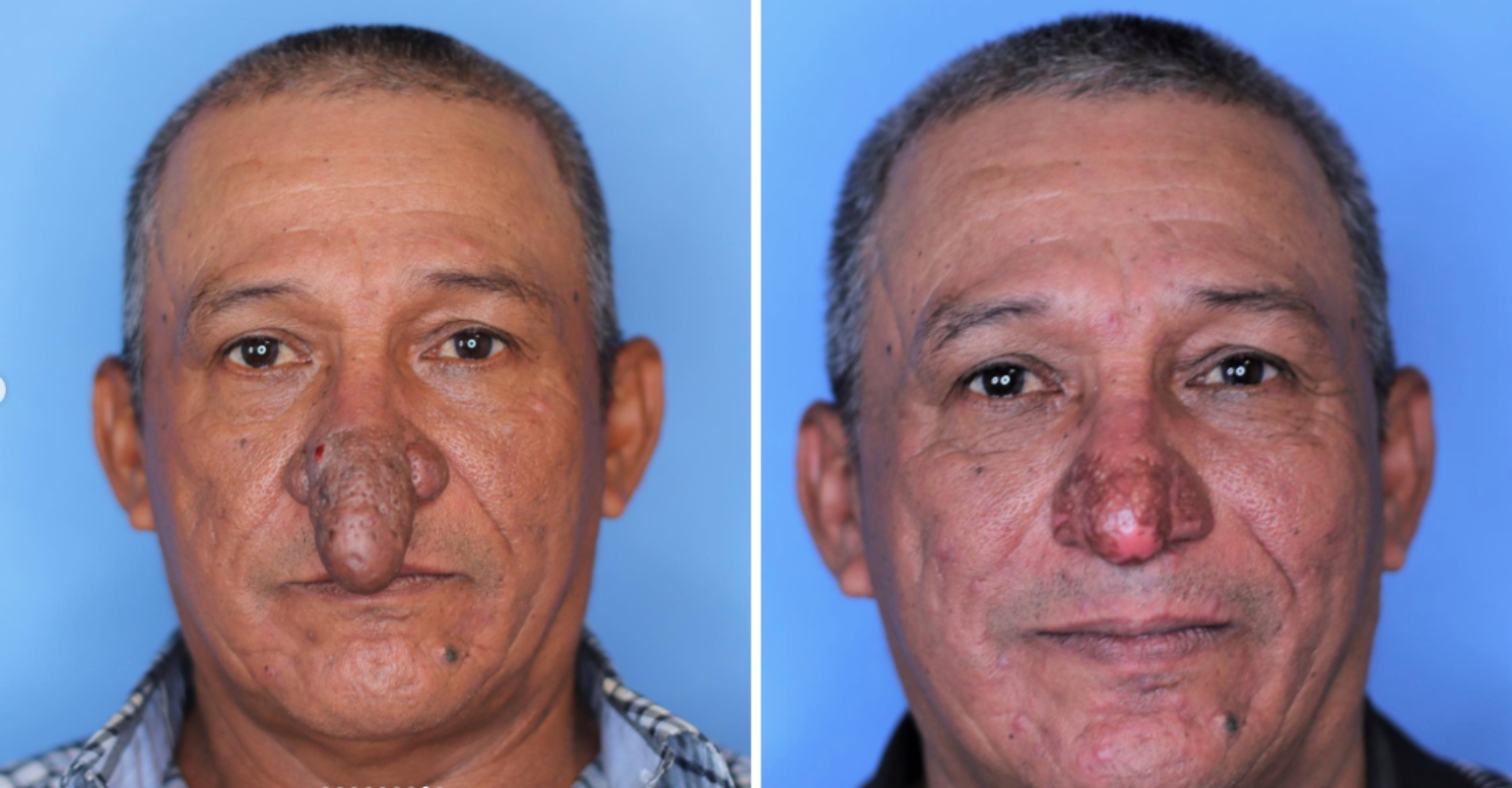 Man Has His Nose Transformed After Cosmetic Surgeon Hires Him To Paint ...