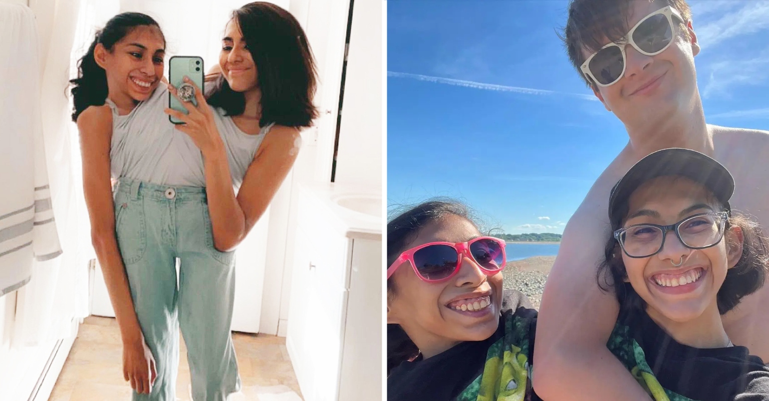 Conjoined Twins Explain How They Make Intimacy Work As One Twin Has A ...