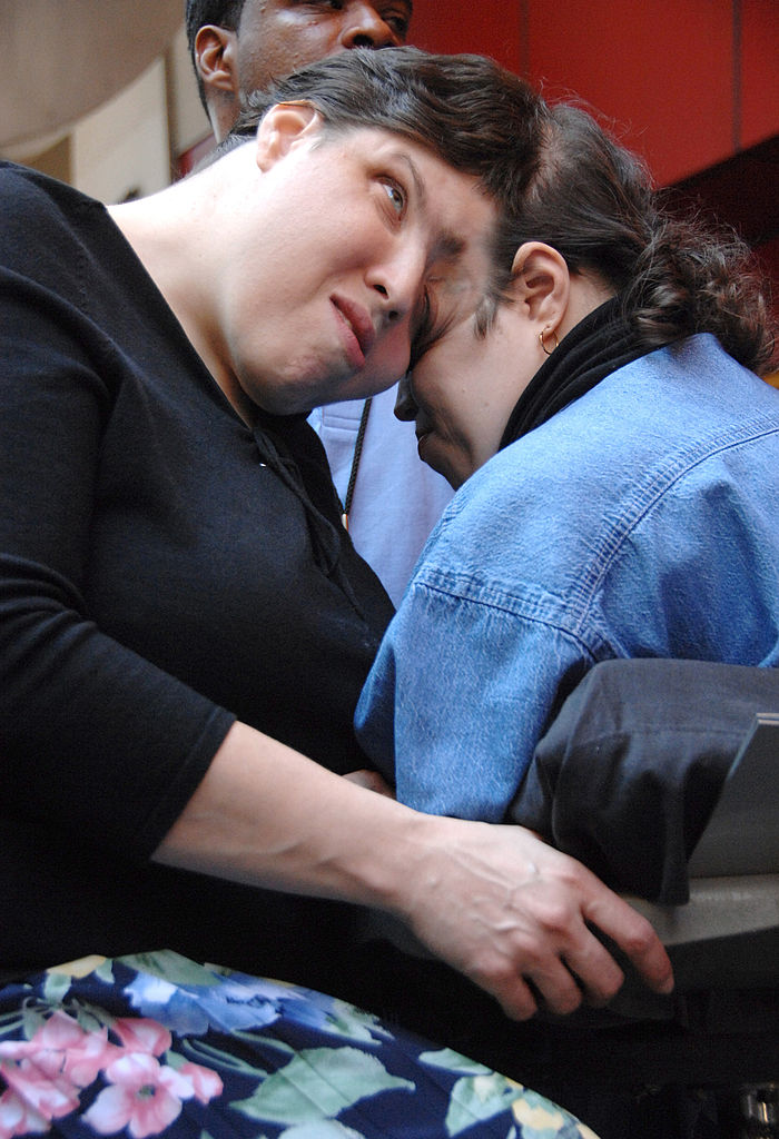 Conjoined Twin Explains How She And Her Brother Make Intimacy Work With ...