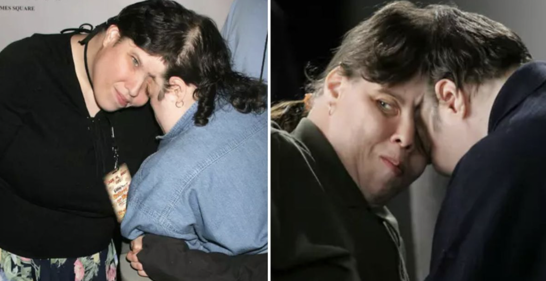 Conjoined Twin Explains How She And Her Brother Make Intimacy Work With ...