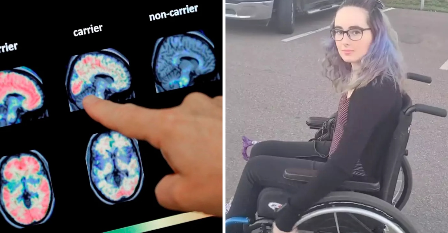 Mysterious Brain Disorder Is Striking Hundreds Of Young People