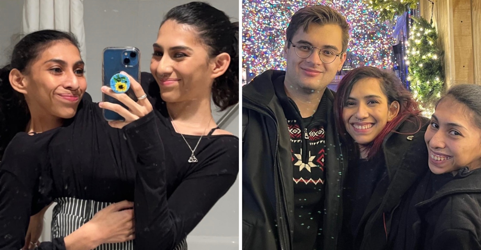 Conjoined Twins Explain How They Make Intimacy Work As One Twin Has A ...