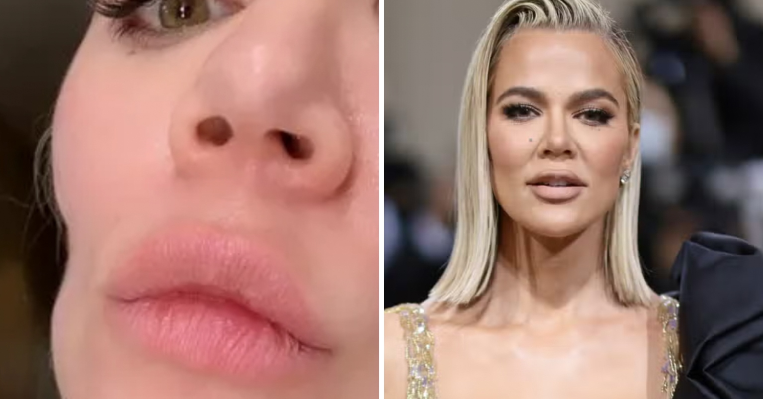 Khloe Kardashian Reveals 'Indentation' In Her Face After Having Cancerous Tumor Removed