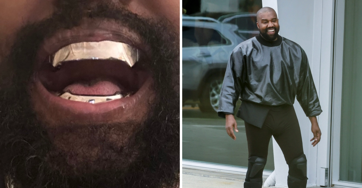 Kanye West 'Has Teeth Removed And Replaced With Titanium Dentures'