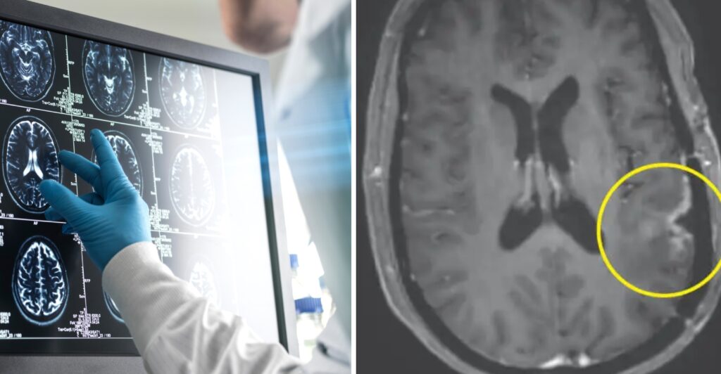 Woman's Brain Tumor 'Almost Disappears' Just A Week In To ...